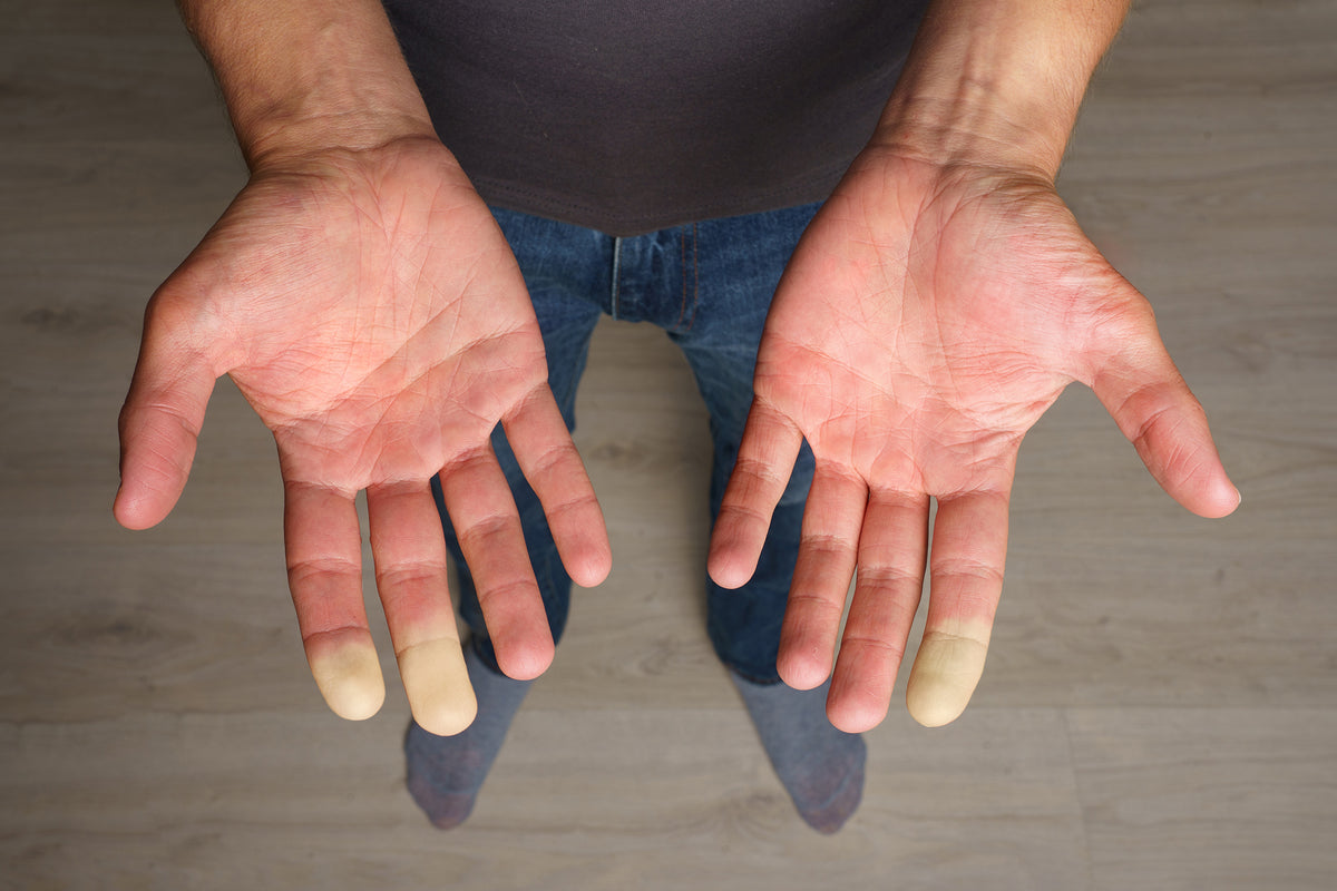 What Causes Raynaud's Disease – Meristem Medicinals